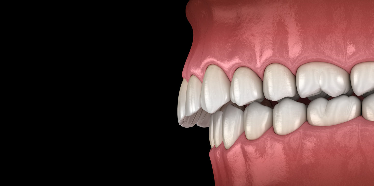 Overbite / Underbite | Carbondale, IL | Oral & Maxillofacial Surgery